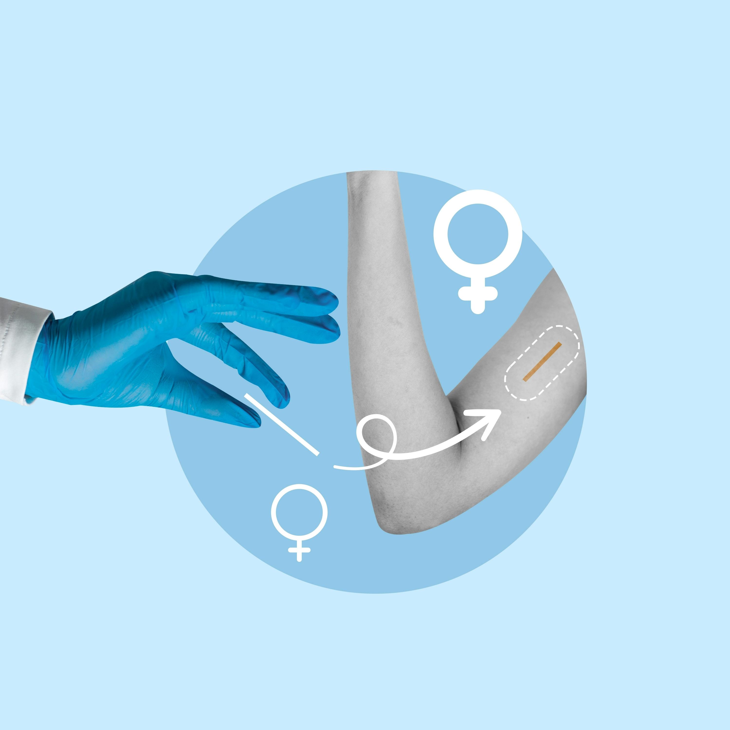 Overvejer du en p-stav? Få alt at vide om fordele, bivirkninger og pris ...